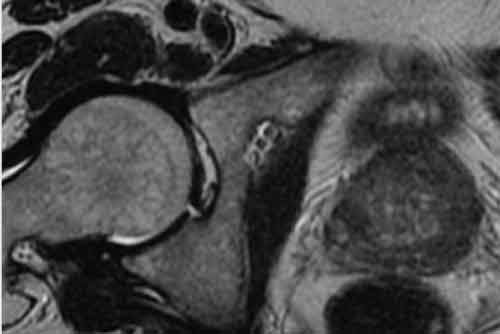 Multiparametric Mri And Prostate Cancer Rga